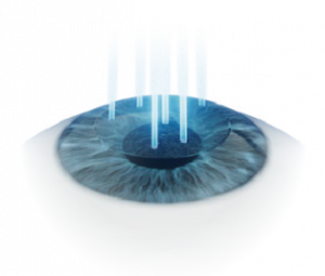 SMART Trans PRK 準分子 - 良視眼科診所